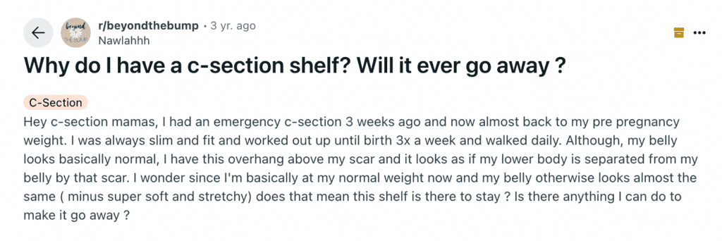 C-Section Shelf: What It Is & How to Get Rid of It